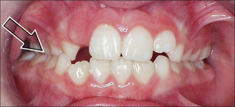 Early Orthodontic Treatment: What Key Biscayne Parents Need to Know